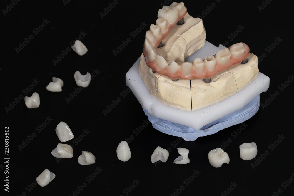 complete Dental kit for total work, ceramic crowns and the basis for ...