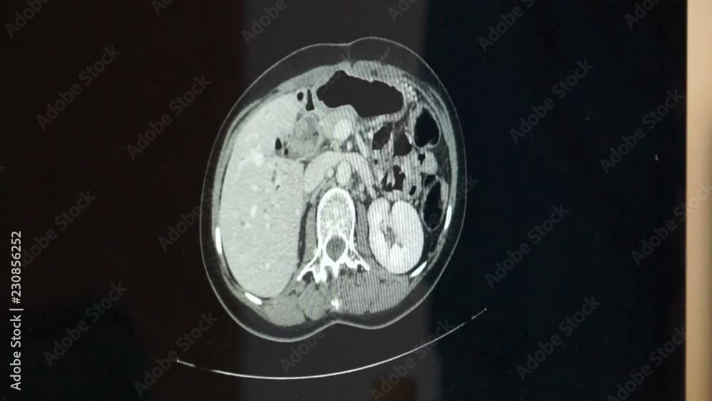 Three head views of MRI scan, MRI brain scan on black background ...