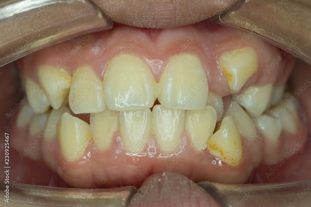 Foto de canine tooth in high position do Stock | Adobe Stock