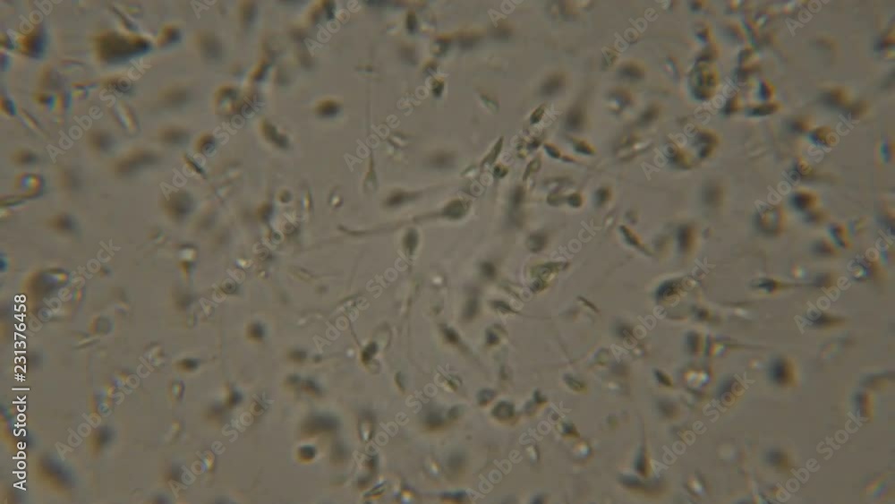 Sperm (spermatozoa) viewed under the microscope. Moving human sperm ...