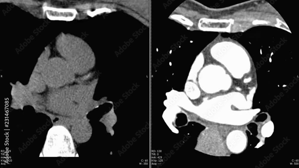 Coronary CT Angiography , computed tomography angiography ( CTA ...
