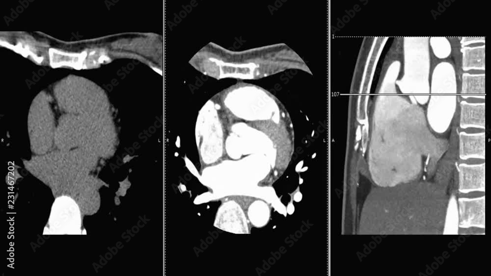 Coronary CT Angiography , computed tomography angiography ( CTA ) Axial ...