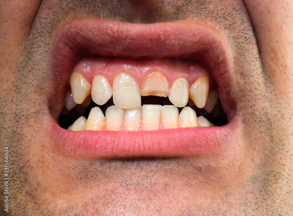 Broken tooth. Broken upper incisor in a man mouth. Man shows oral ...