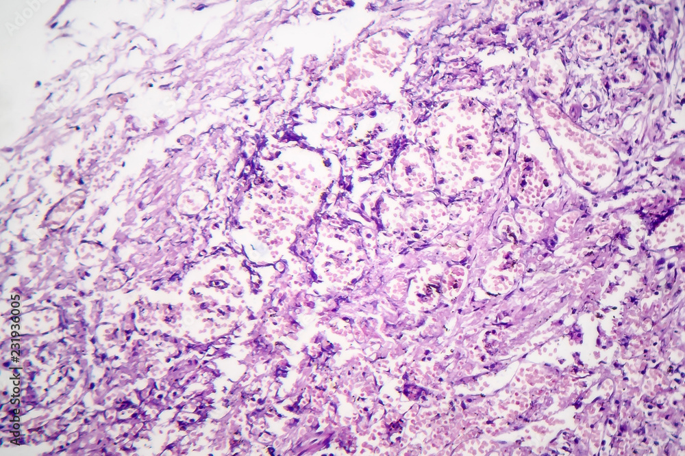 Histopathology of viral pneumonia Stock Photo | Adobe Stock