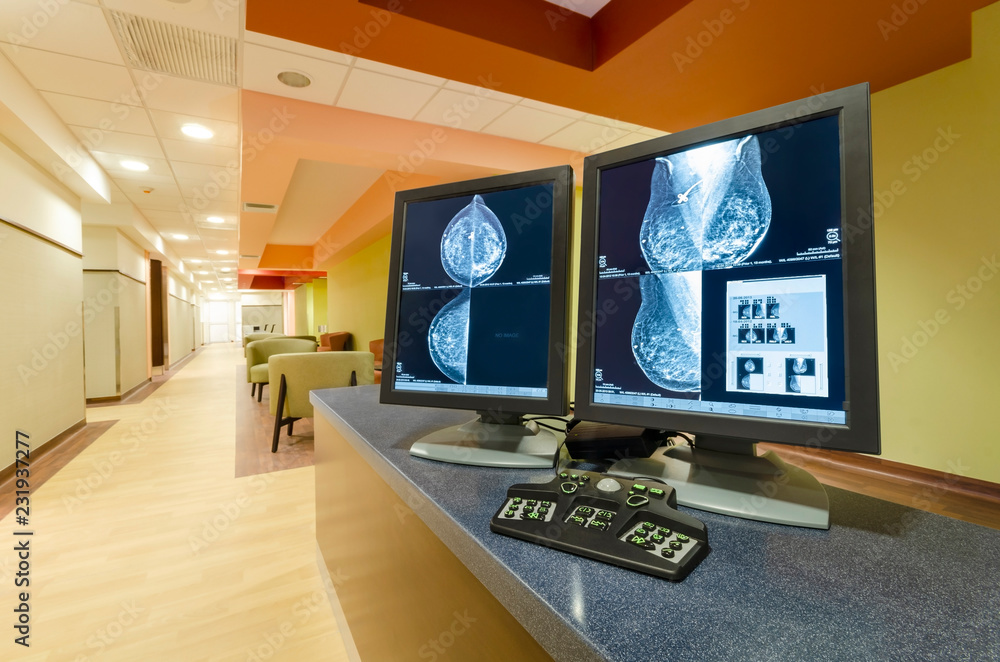 Mammogram images of breasts of a female patient. Screening possible ...