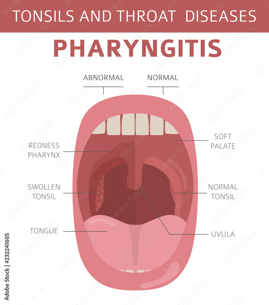 Tonsils and throat diseases. Pharyngitis symptoms, treatment icon set. Medical infographic ...