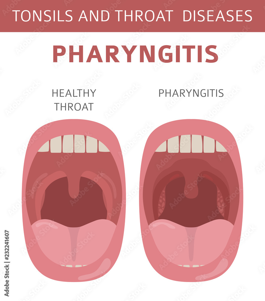 Tonsils and throat diseases. Pharyngitis symptoms, treatment icon set ...