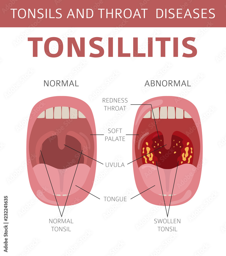Tonsils and throat diseases. Tonsillitis symptoms, treatment icon set ...
