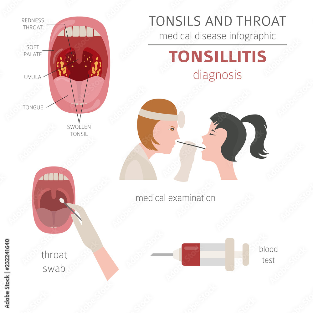 Tonsils and throat diseases. Tonsillitis symptoms, treatment icon set ...
