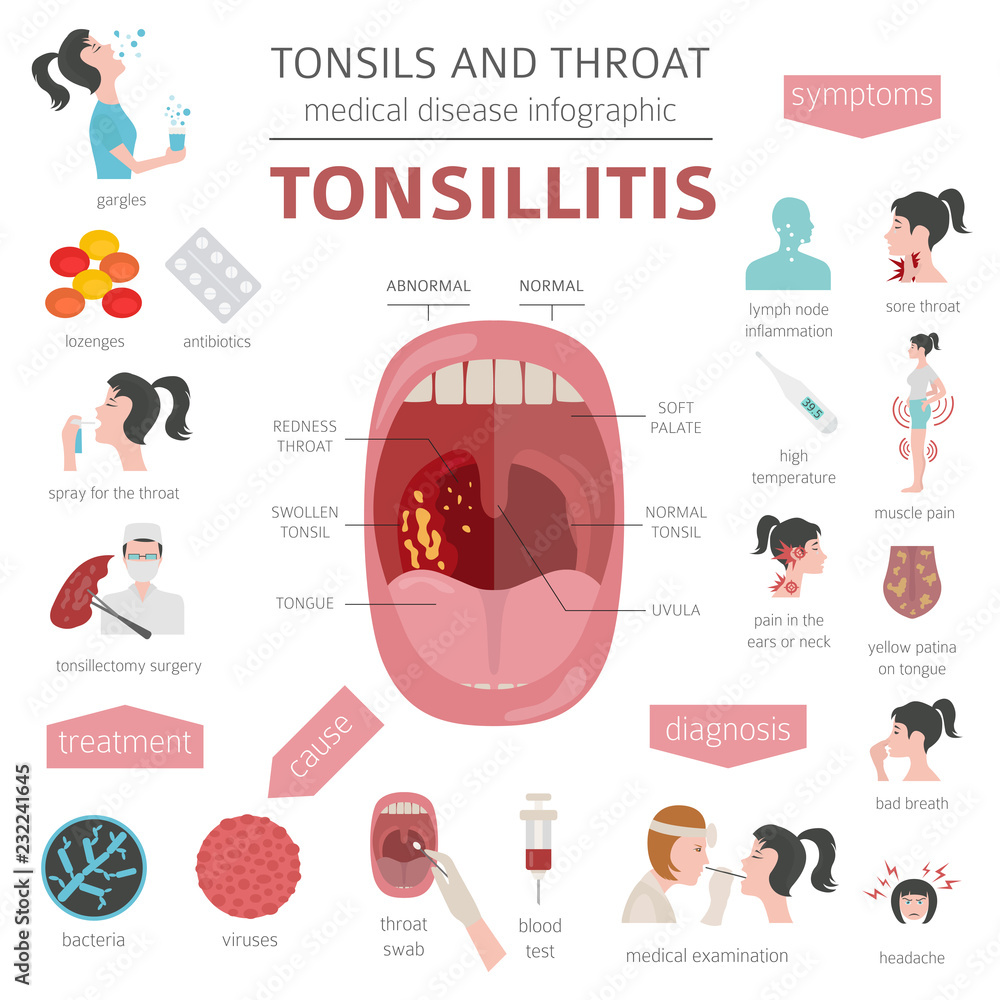 Tonsils and throat diseases. Tonsillitis symptoms, treatment icon set. Medical infographic ...
