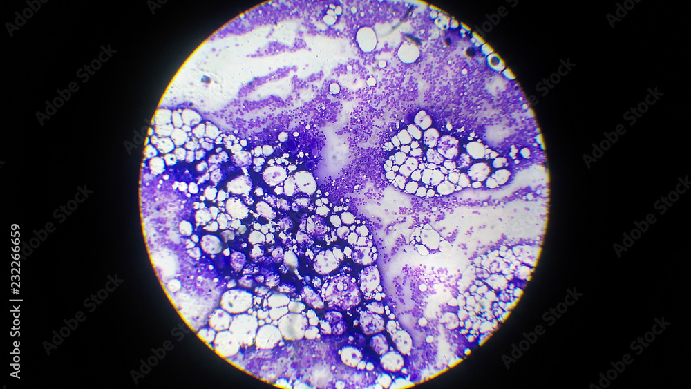 Abnormal cell in pleural effusion under microscope Stock Photo | Adobe ...