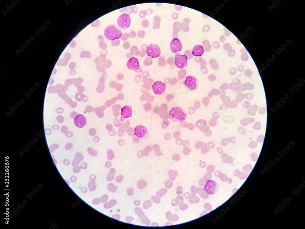 Blood human abnormal cell (Blast cell) Stock Photo | Adobe Stock