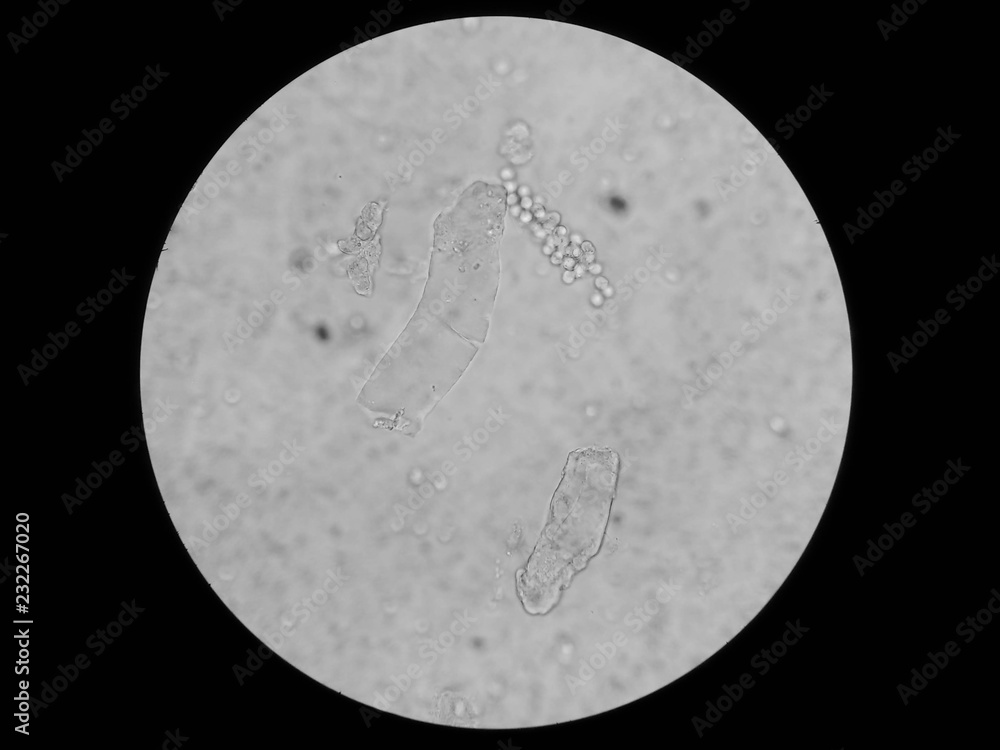 Significance Cast of Urinary under 40X light microscope, Waxy cast ...
