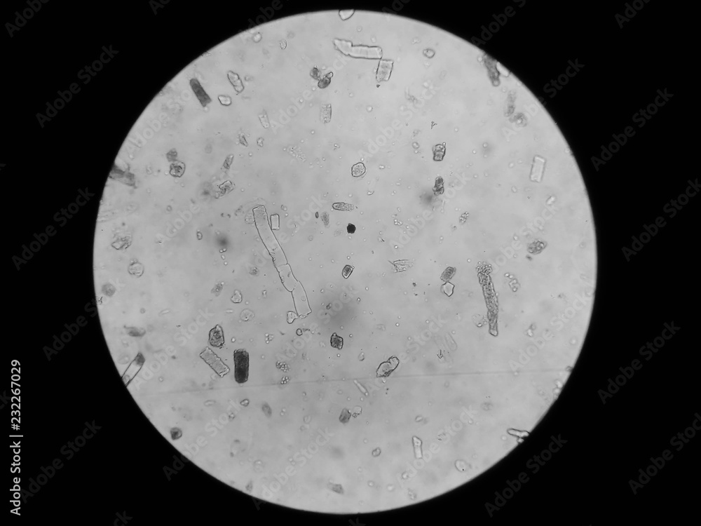 Significance Cast of Urinary under 40X light microscope, Waxy cast ...