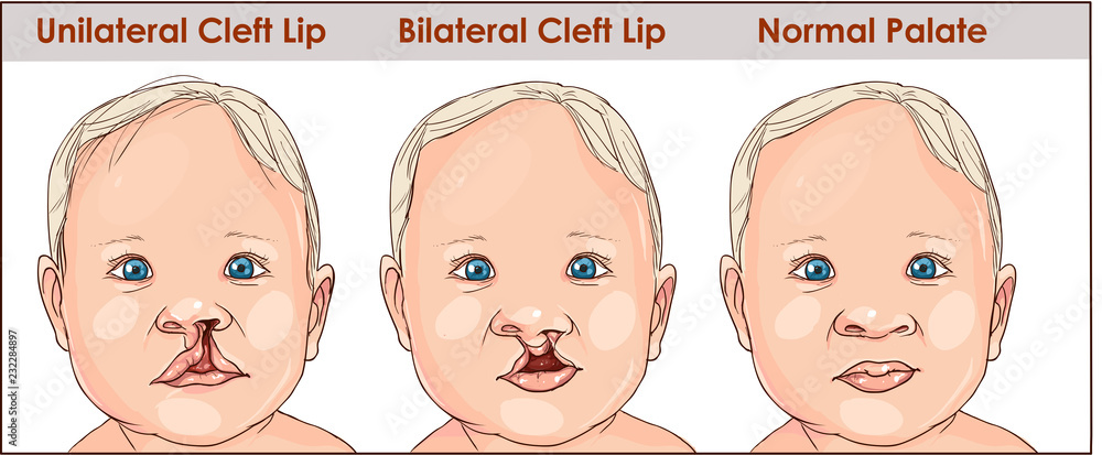illustration of a cleft palate in a child. plastic surgery ...