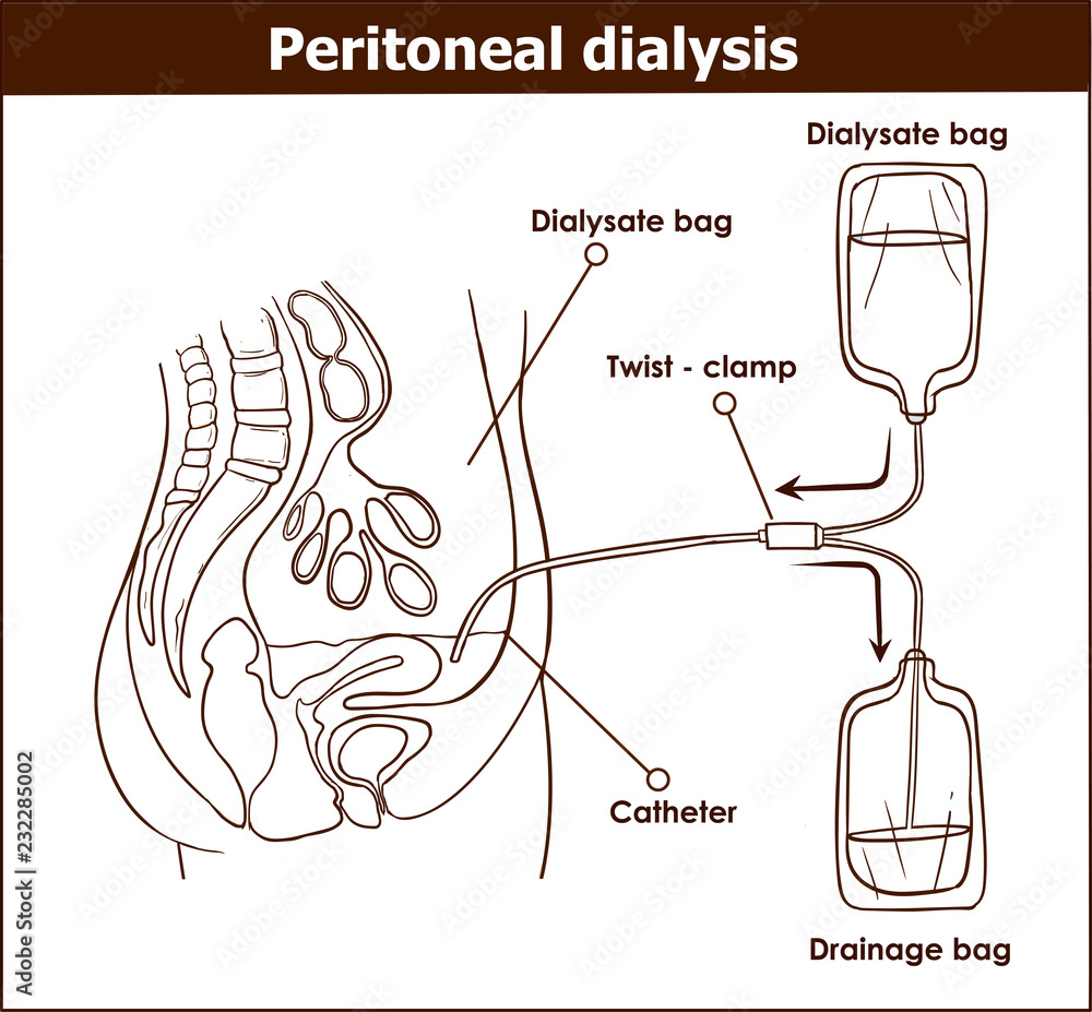 peritoneal dialysis are both used to treat kidney - vector illustration ...