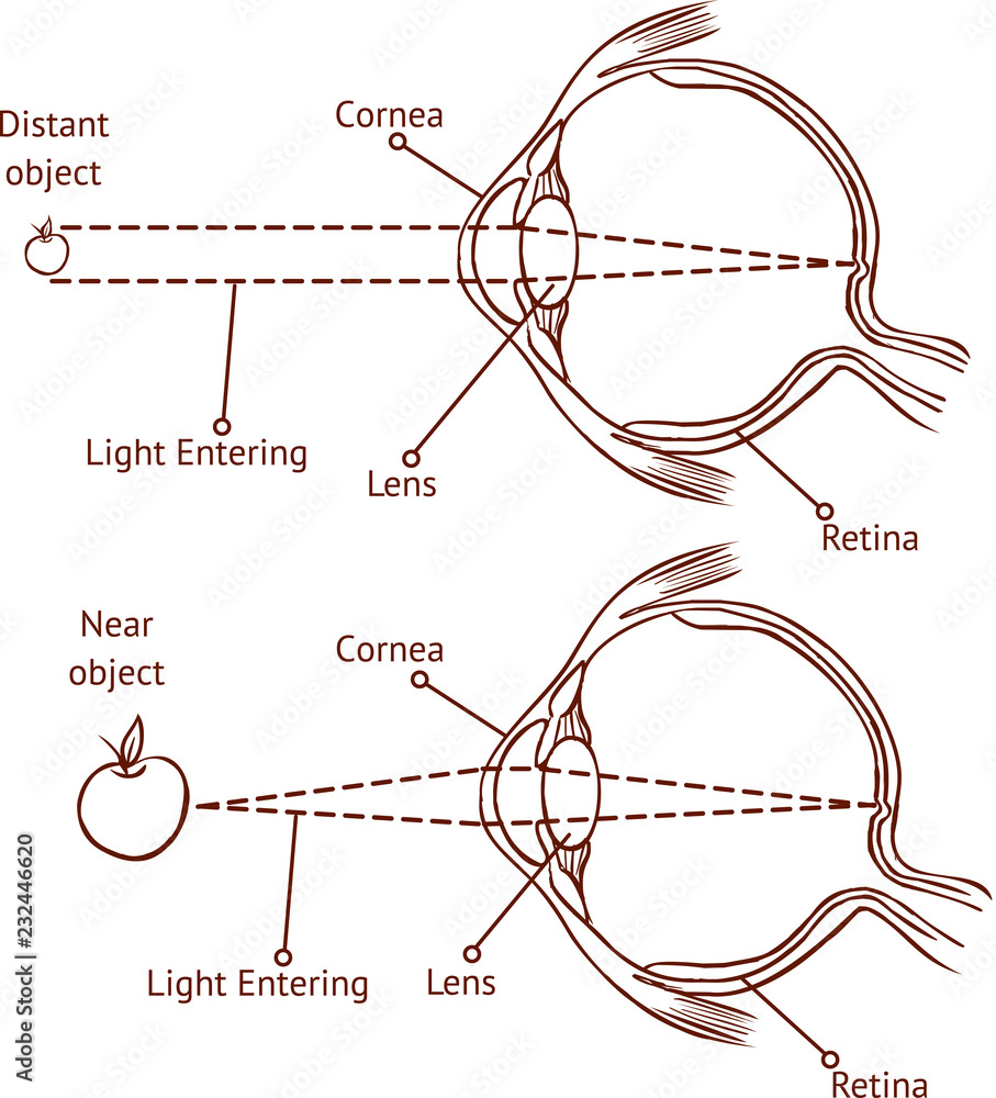 Myopia and normal vision ( color vector illustration ) Stock Vector ...