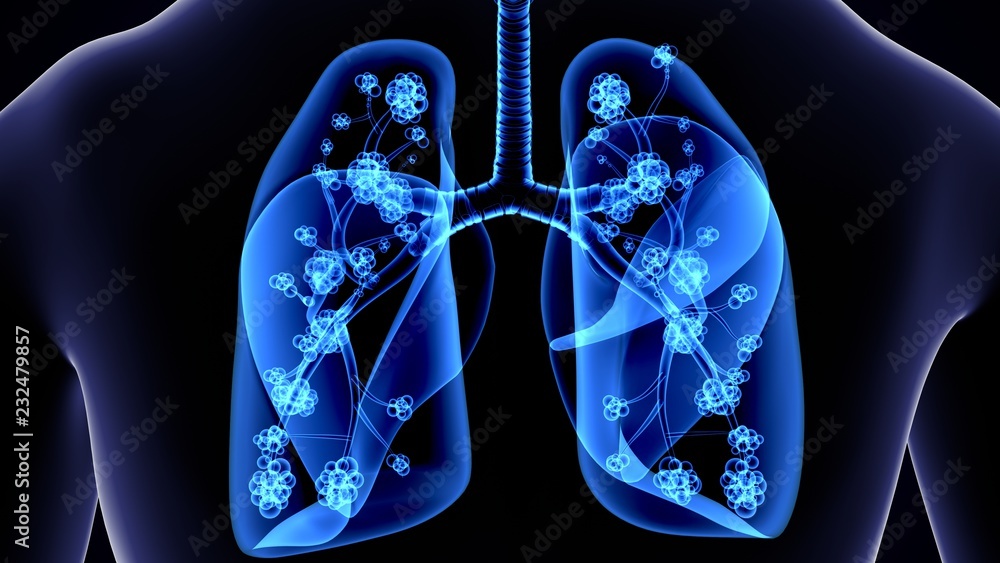 Photo & Art Print Secondary tuberculosis in lungs, apical nodule, 3D ...