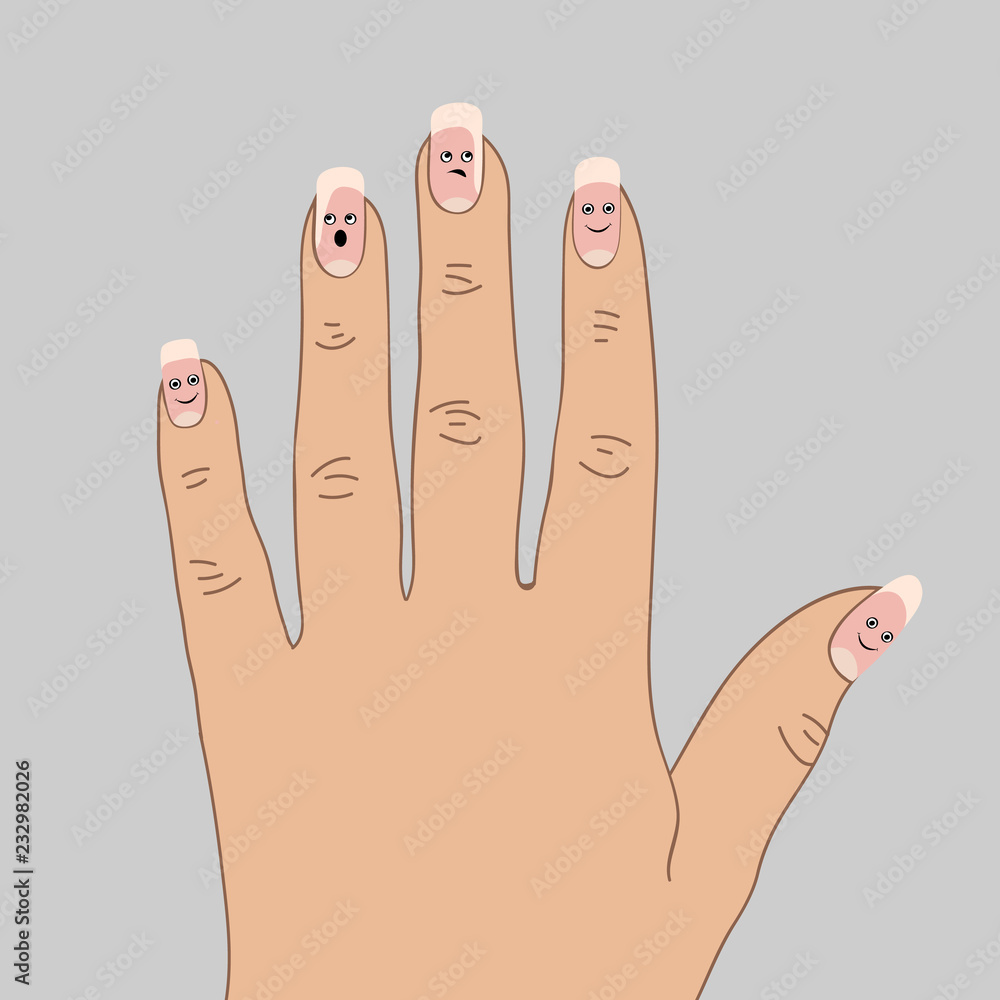 Detachment of the nail plate from the nail bed. Cartoon illustration ...