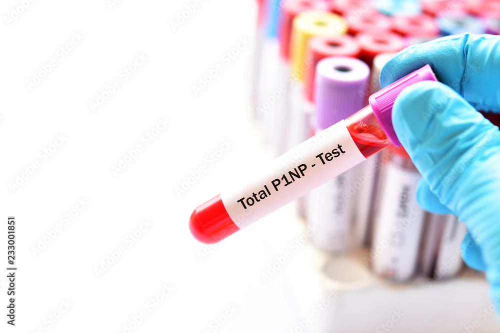 Blood sample tube for total P1NP test, diagnosis for bone disease Stock ...