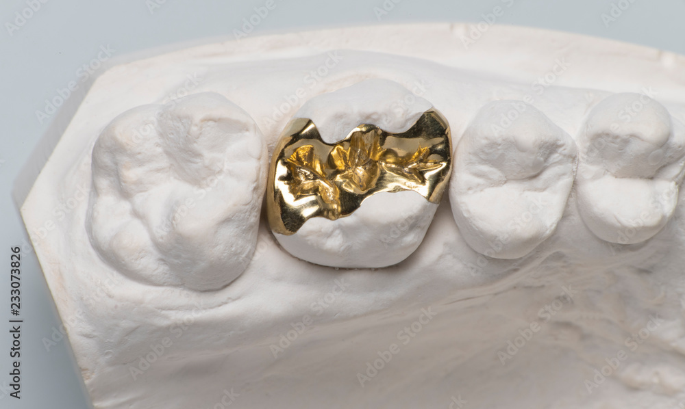 Goldinlay auf weißem Modell Stock Photo | Adobe Stock