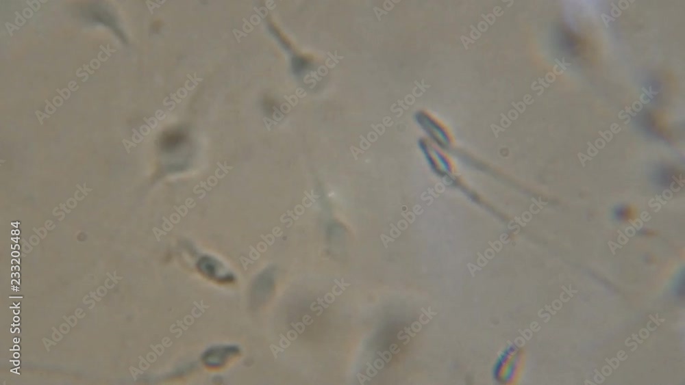 Sperm Spermatozoa Viewed Under The Microscope Moving Human Sperm