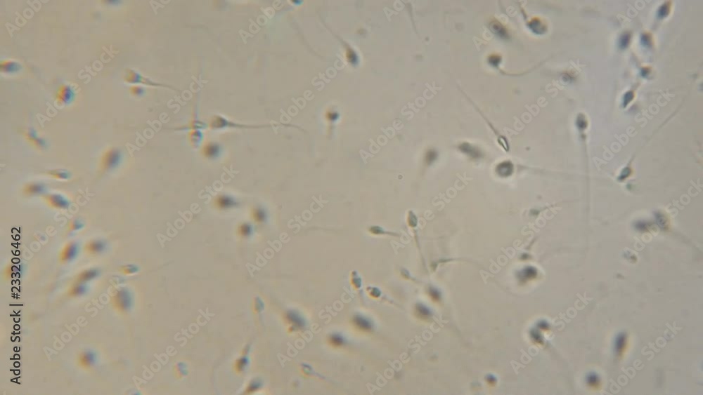 Sperm (spermatozoa) viewed under the microscope. Moving human sperm ...