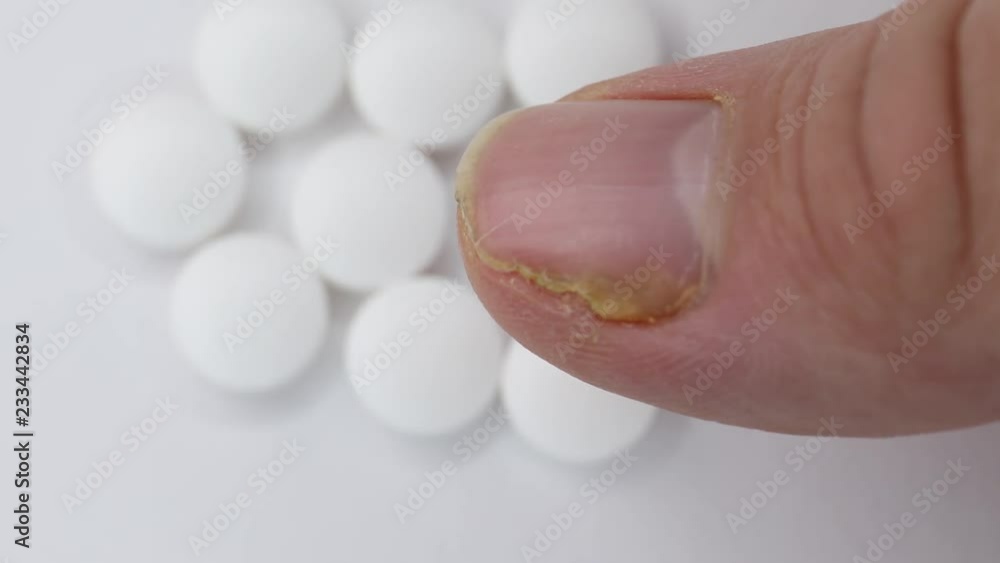 Close up of nail fungus infection on the thumb finger. Fungal infection ...