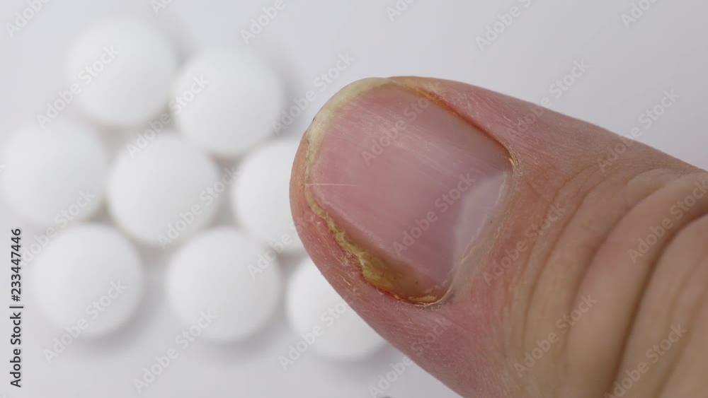 Close up of nail fungus infection on the thumb finger. Fungal infection ...