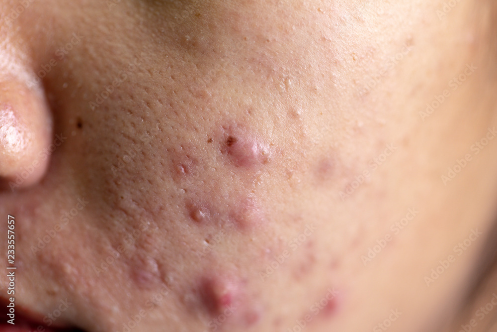 Backgrounds of lesions skin caused by acne on the face in the clinic ...