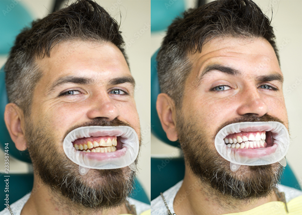 White teeth - before and after concept. Close-up detail of man teeth ...
