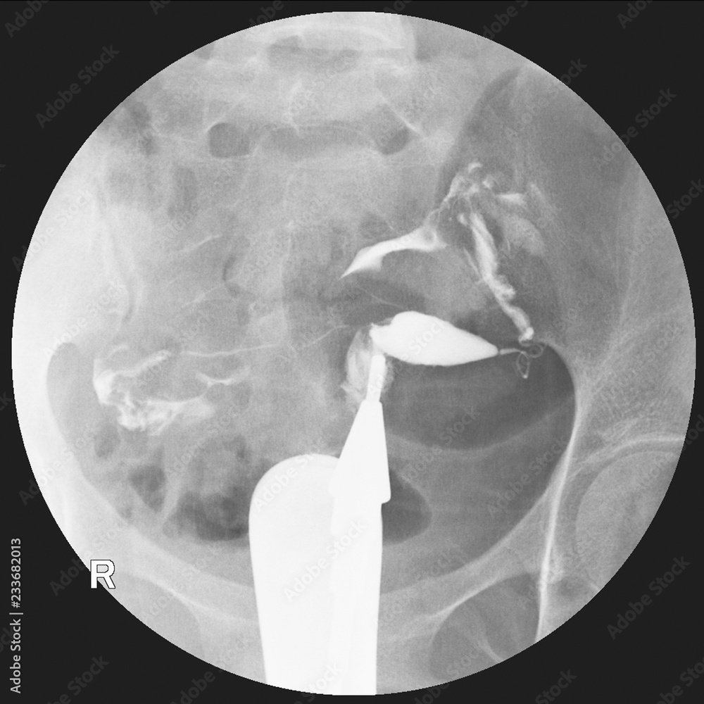 Hysterosalpingography (HSG) is a fluoroscopic X-ray study of a woman's ...
