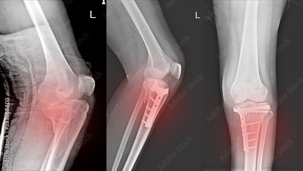 X-ray Knee Joint Fracture proximal tibia and Post fix fracture proximal ...