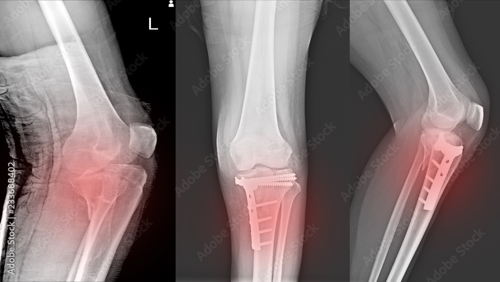 Anatomía De La Tibia Proximal