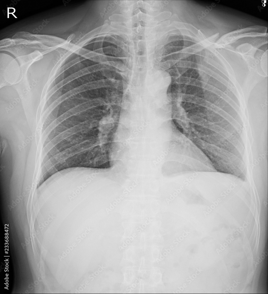 Chest x-ray Fractures left clavicle, anterior 2nd rib, posterior rib 4 ...