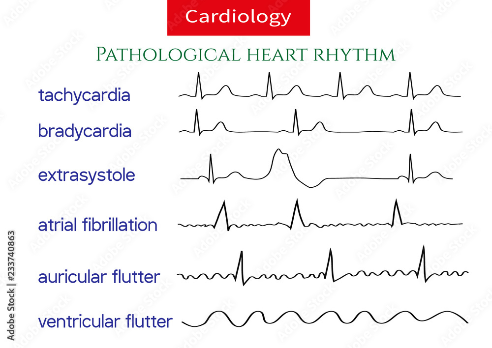 Pathological ecg collection. Stock Vector | Adobe Stock