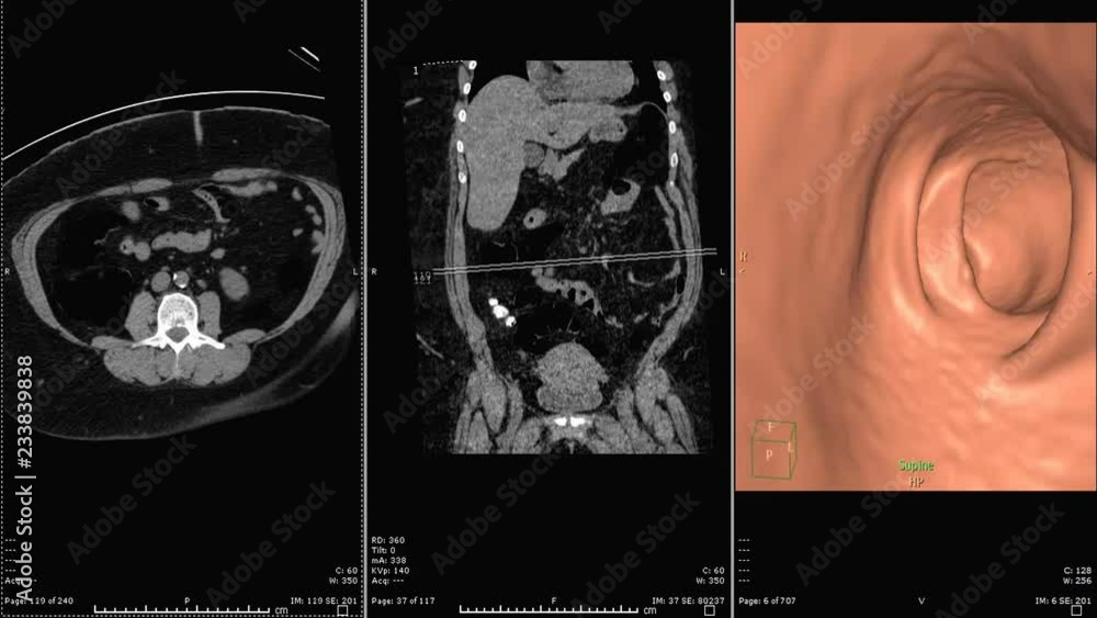 CT colonography or CT Scan of Colon axial view vs Coronal view and 3D ...