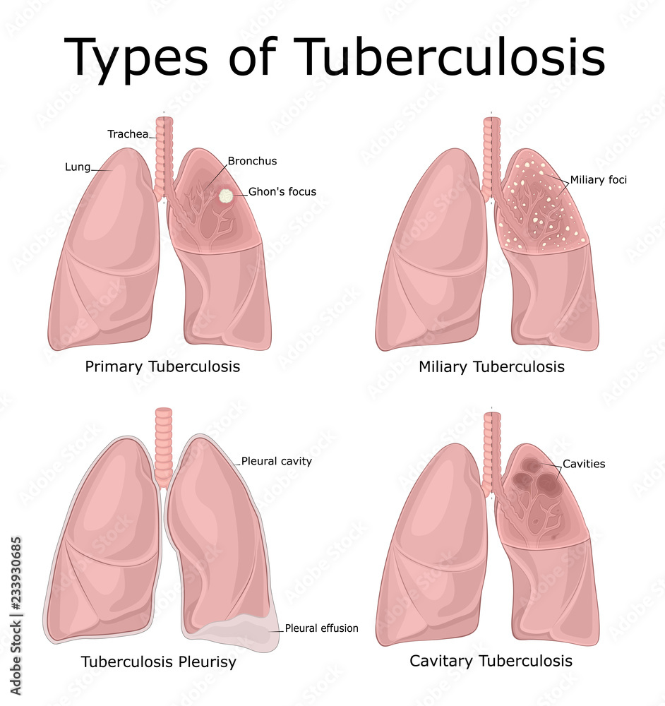 Types of Tuberculosis Stock Vector | Adobe Stock