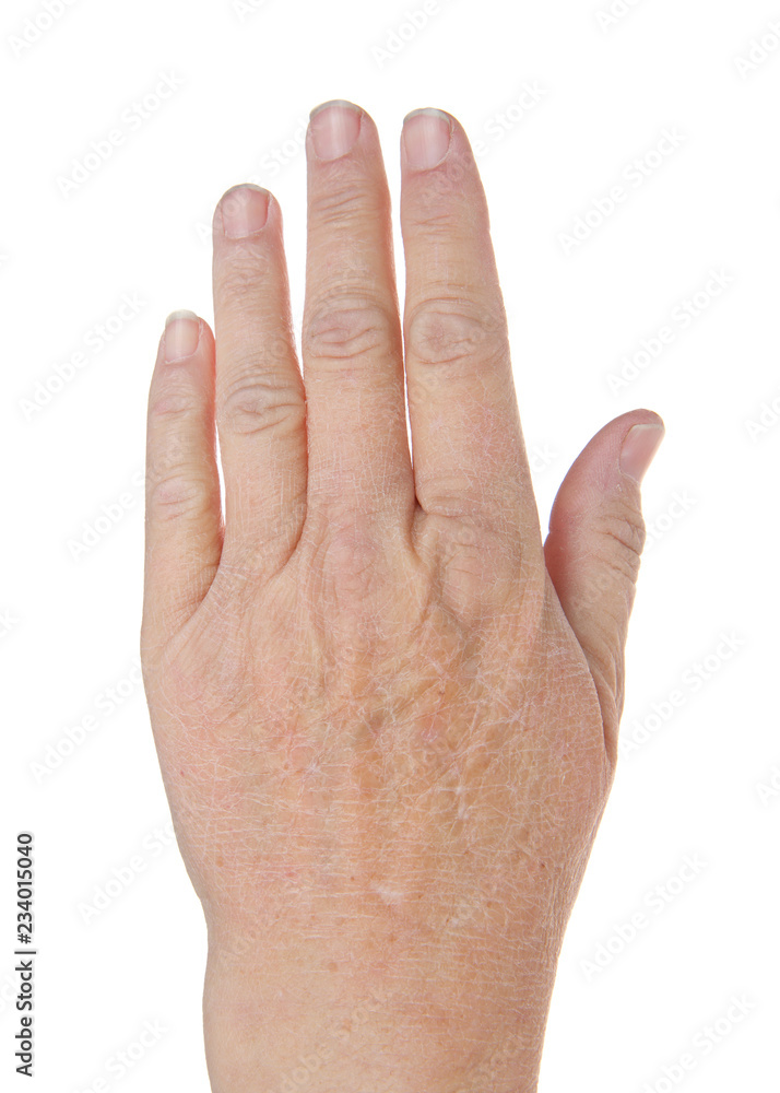Adult caucasian hand isolated on white background with very dry cracked ...