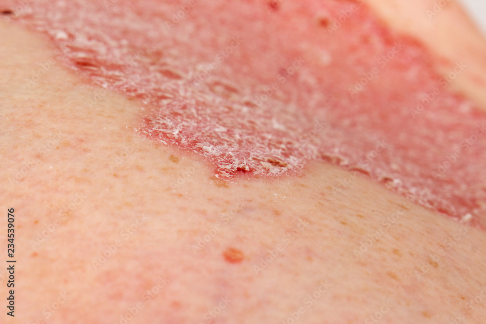 Psoriasis Vulgaris - detail of psoriatic skin disease, an autoimmune ...