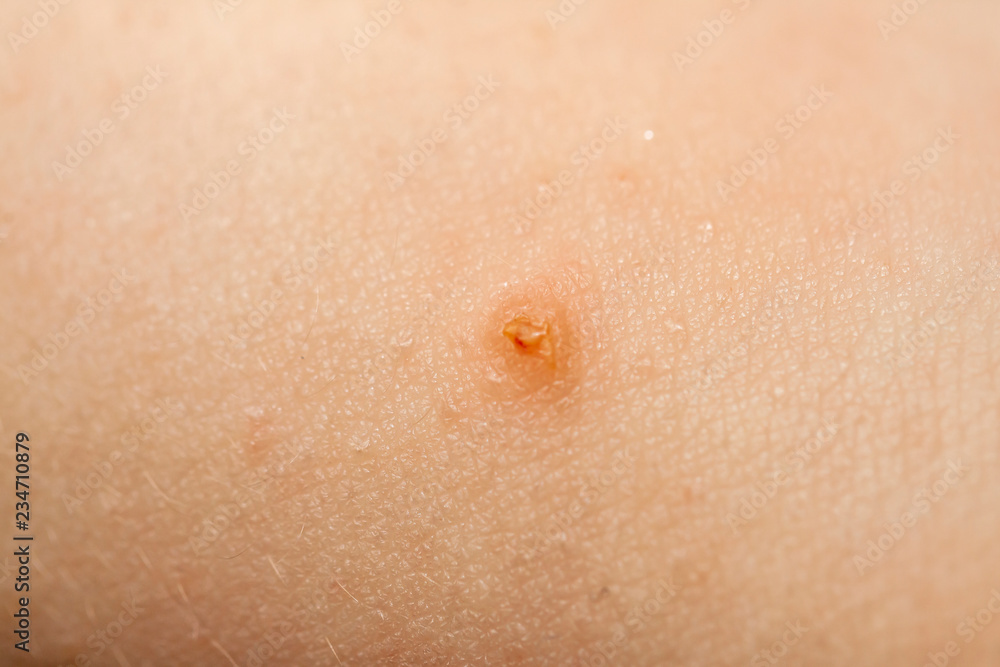 Close up of Molluscum Contagiosum also called water wart Stock Photo ...