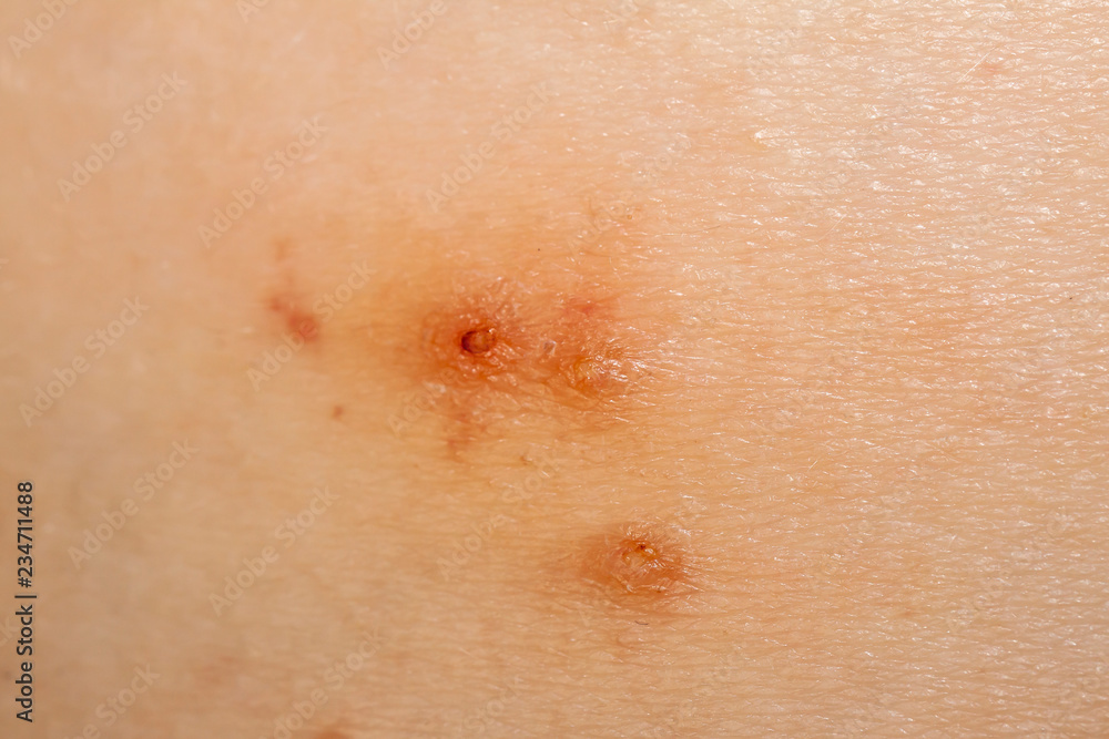 Close up of Molluscum Contagiosum also called water wart Stock Photo ...