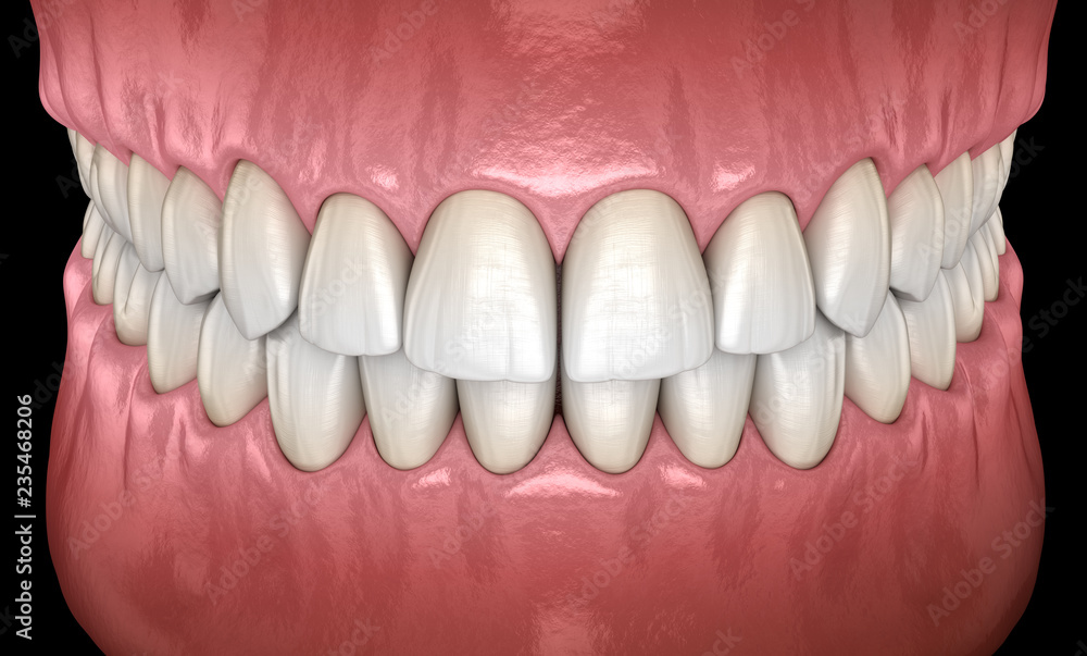 Healthy human teeth with normal occlusion frontal view. Medically ...