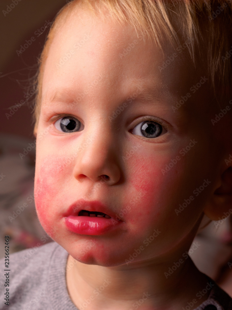 Little child with diathesis symptoms on cheeks, closeup. Surprised ...