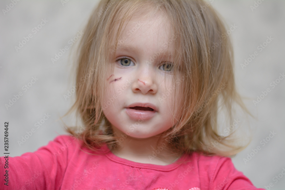 Child Bruised Face