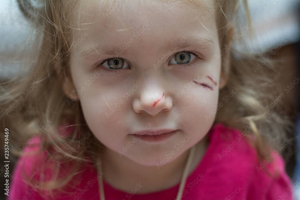 Physical injury blood wound skin child pain, Inflicted on the child's ...