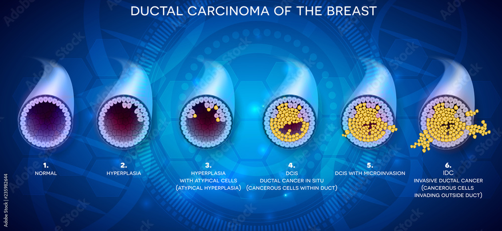 Ductal carcinoma of the breast, detailed medical illustration. At the ...