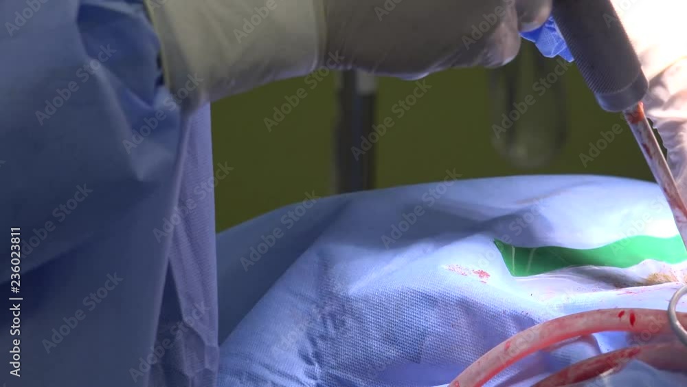 Spinal fusion, also called spondylodesis or spondylosyndesis, is a ...