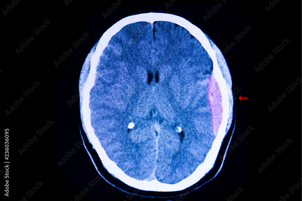 Brain CT scan, epidural hemorrhage Stock Photo | Adobe Stock
