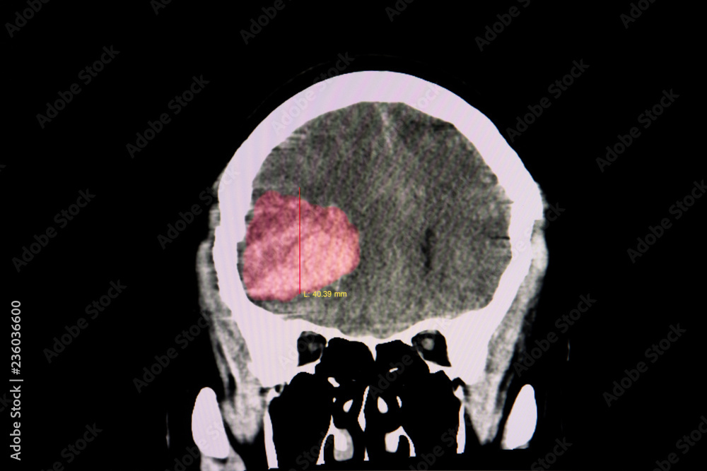 Brain CT scan, intracerebral hemorrhage Stock Photo | Adobe Stock